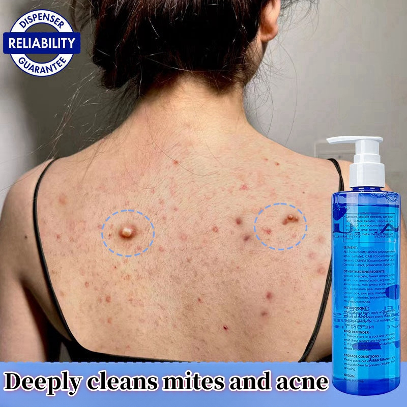 Acne body wash 300ml back acne body wash whitening shower gel ...
