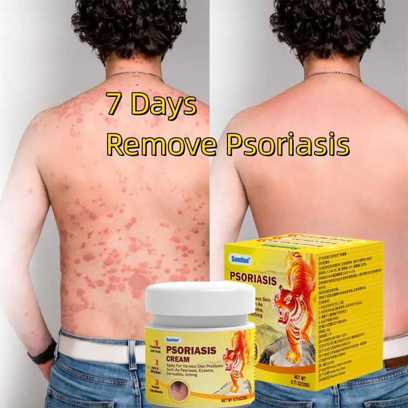 Psoriasis Cream Eczema Ointment Repair Dermatitis Ringworm Relief Dry ...