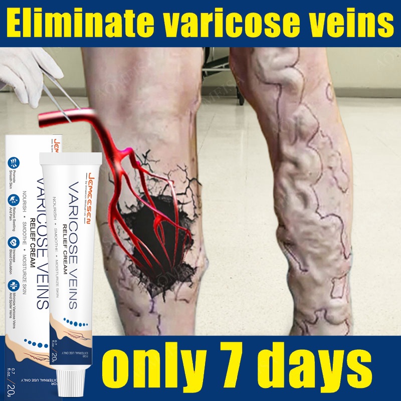 Jemeesen Varicose Veins Cream Removal Varacous Vein Spider Vein Pain ...