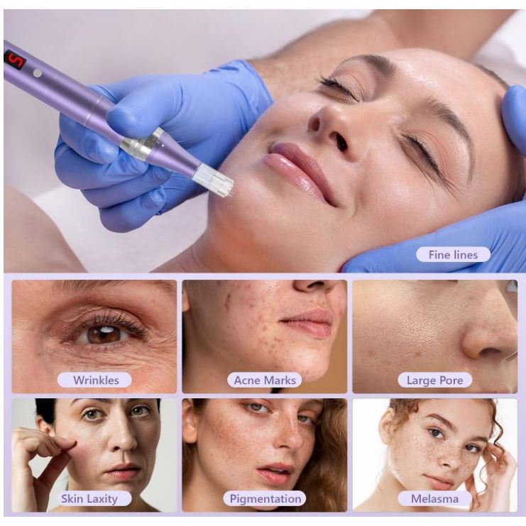 5 Speed Wireless Derma Pen Microneedling Cartridges Dr Pen Roller ...