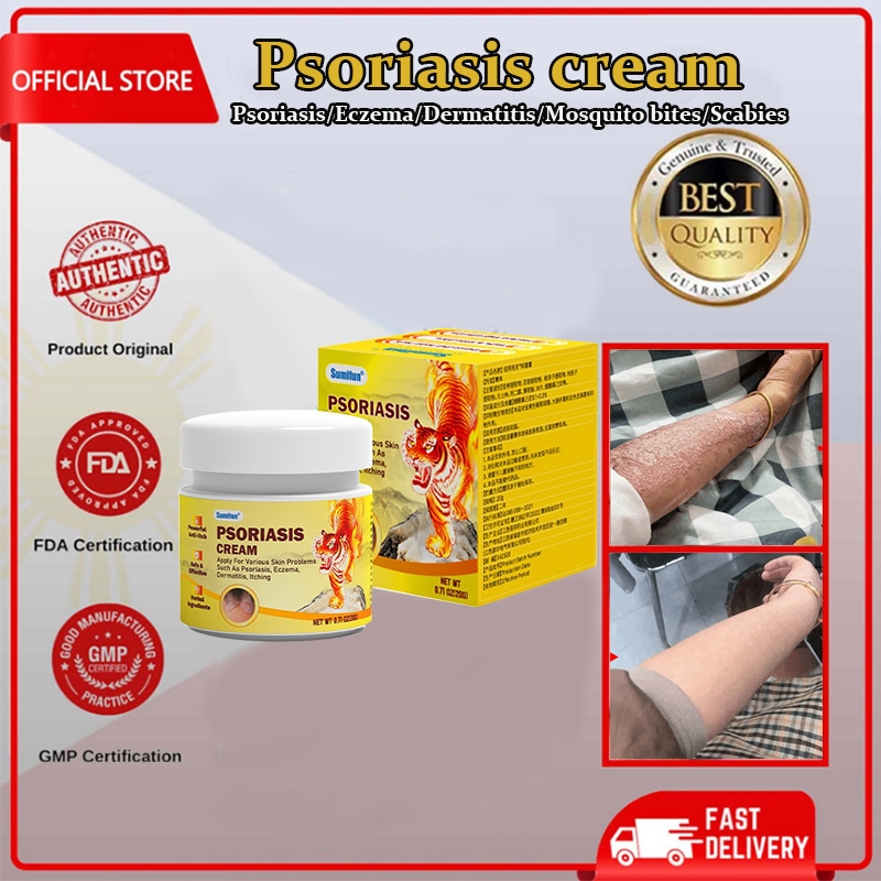 antifungal cream eczema cream and psoriasis ointment Skin itching cream ...
