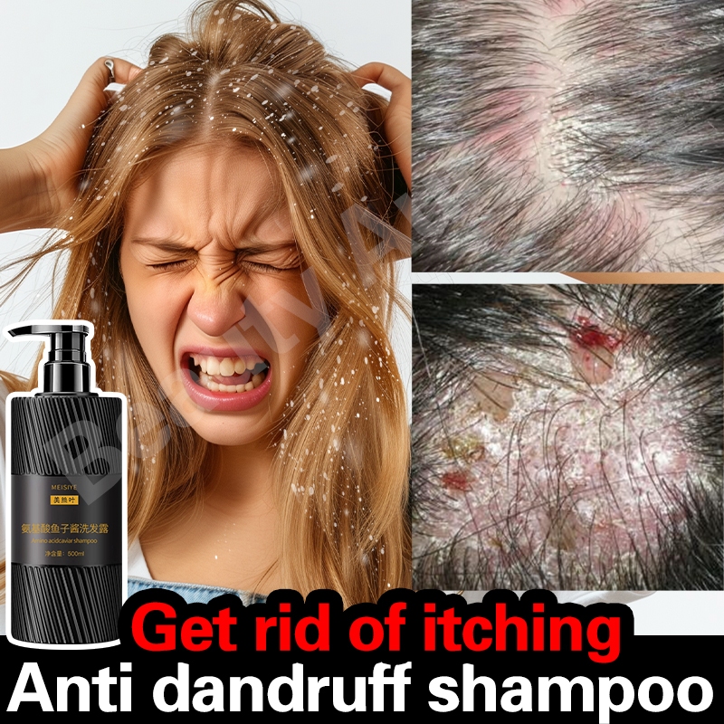 Anti-dandruff shampoo for oily scalp 500ml caviar amino acid anti-dandruff oil relieves itching ...