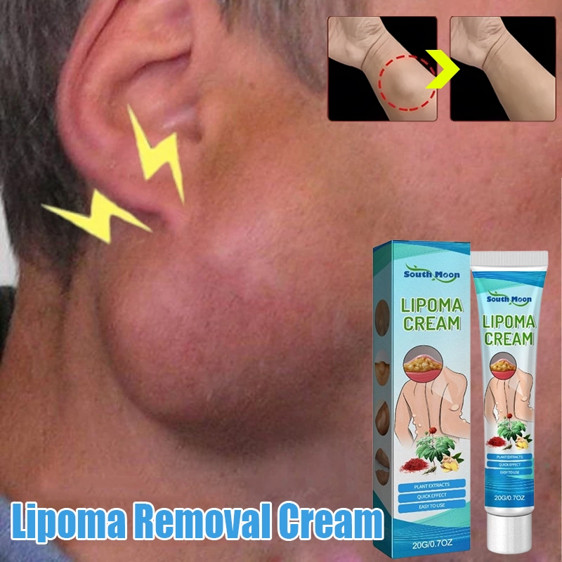 Lipoma Removal Cream Lipoma Cream Removing Lumps in the Body Treat ...