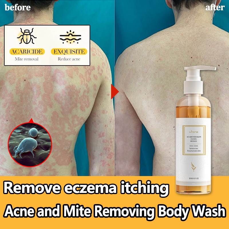 eczema body wash eczema lotion anti itch anti mite anti fungal acne body wash antibacterial ...