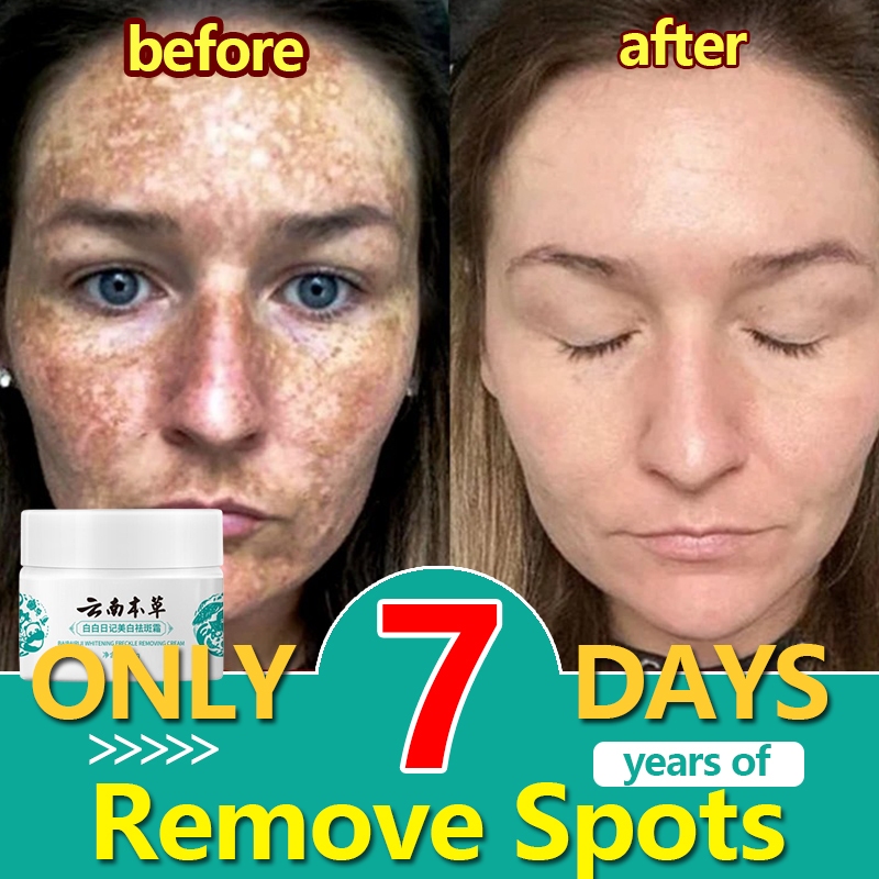 dark spot cream freckles removal face whitening anti ageing melasma and ...