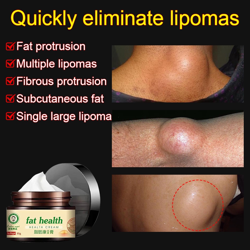 Lipoma Removal Cream 30g Eliminate lipoma Removing Lumps Neck Armpit ...
