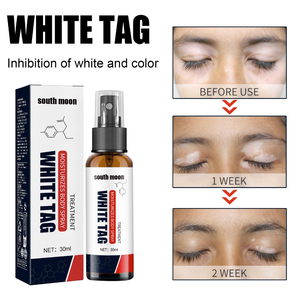 Vitiligo spray 30ml White Spot Treatment Sweat Spot Piebald Spots ...