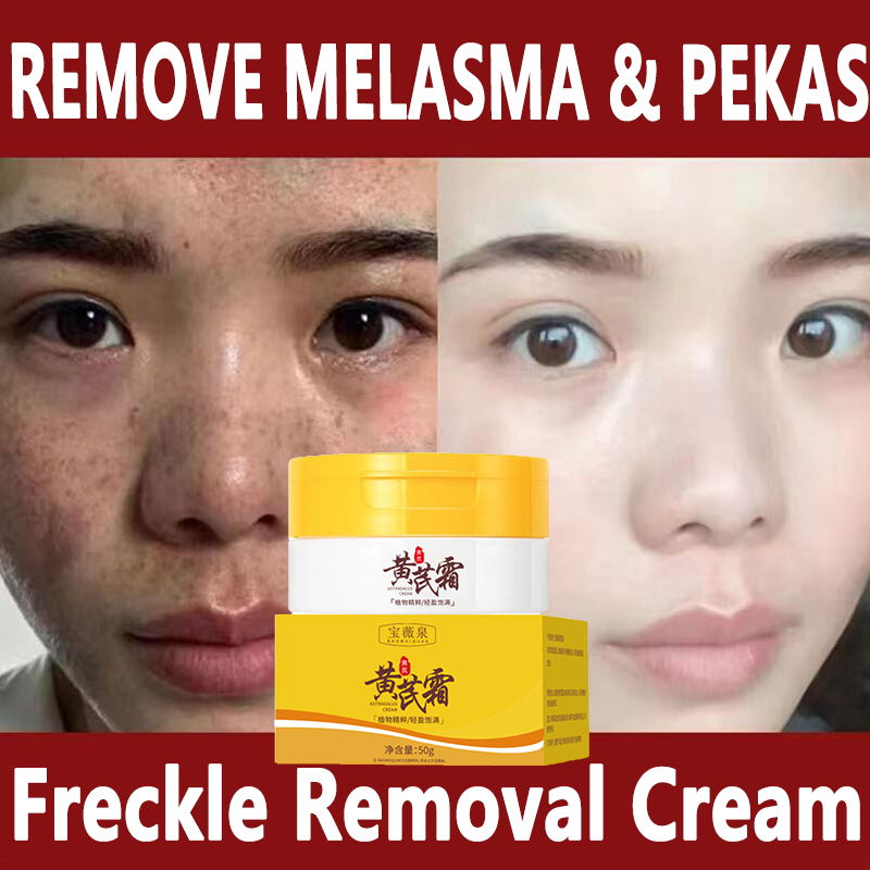Melasma Cream Freckles Removal Cream Centella Pigmentation Dark Spot ...