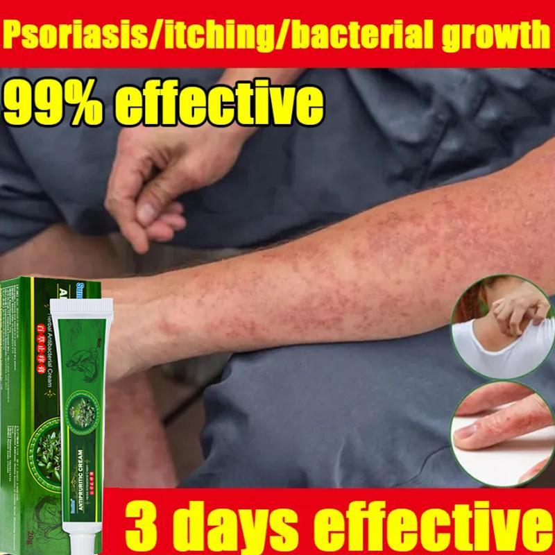 Anti-itch cream effectively alleviates skin itching, rashes, dryness ...