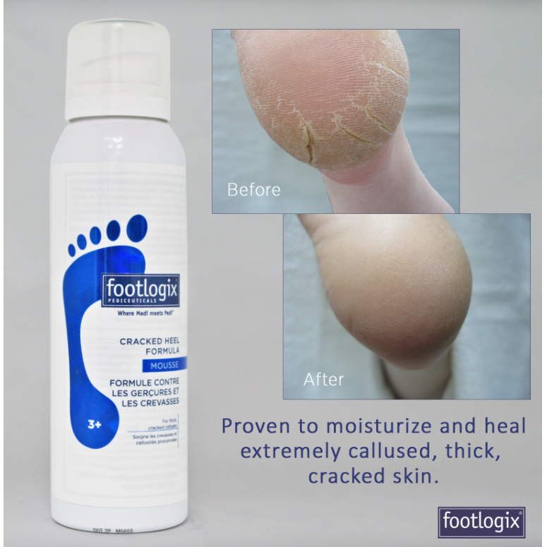 Footlogix Cracked Heel | Callus Softener | Prolinc Callus Eliminator ...