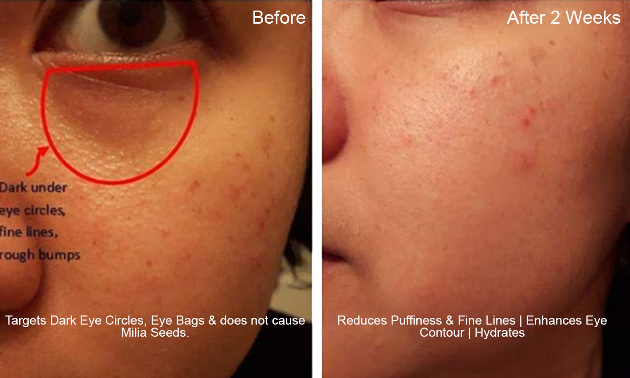 AUOLIVE EYES LIFTER Eye Serum - Reduces Dark Eye Circles, Puffiness ...