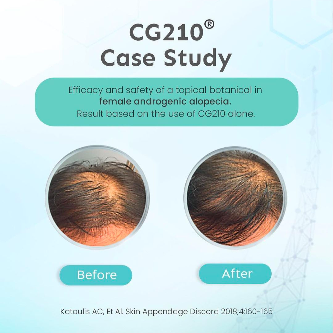 CG210 Hair Growth Essence Men Women Forte | Thicker Hair in 44 Days ...