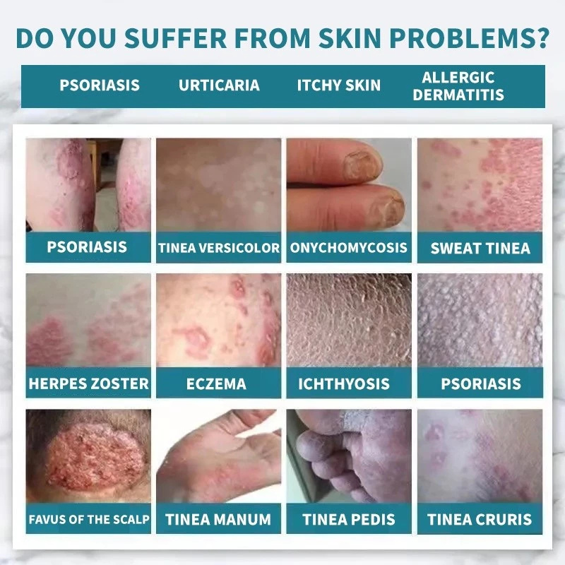 Japan Eczema Anti Itch Cream Psoriasis Antifungal Cream Dermatitis Private Part Itchy Repairs ...