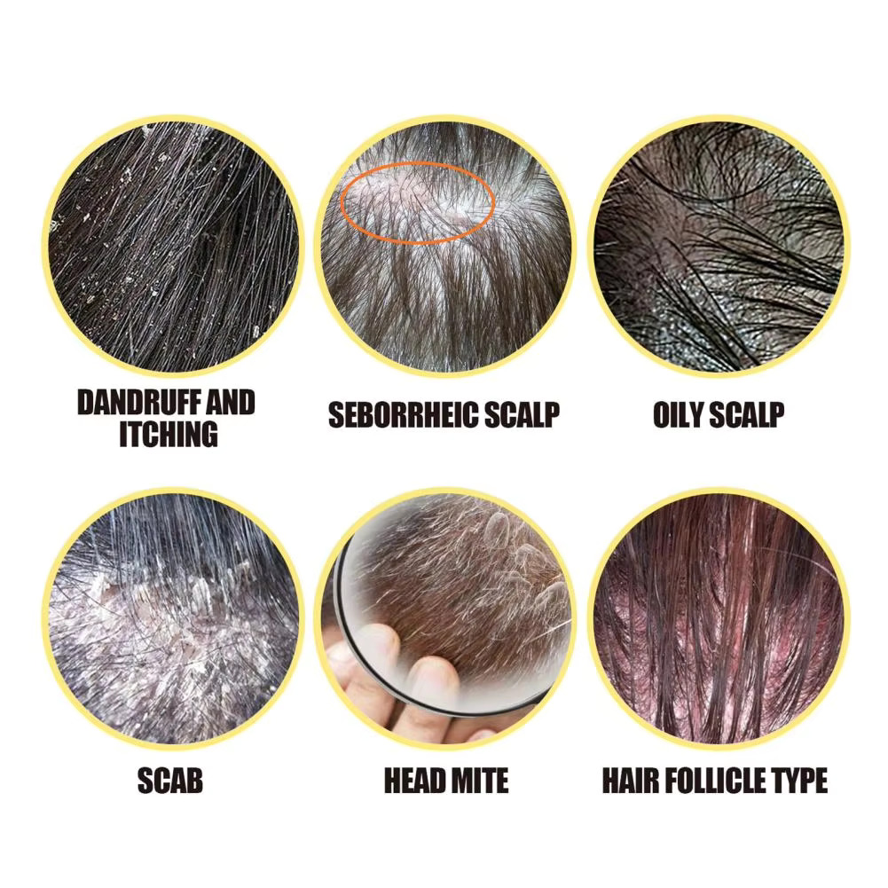 Hair Lice and Demodex Mites Removal - Sulfur Hair Treatment Mask 50ml ...