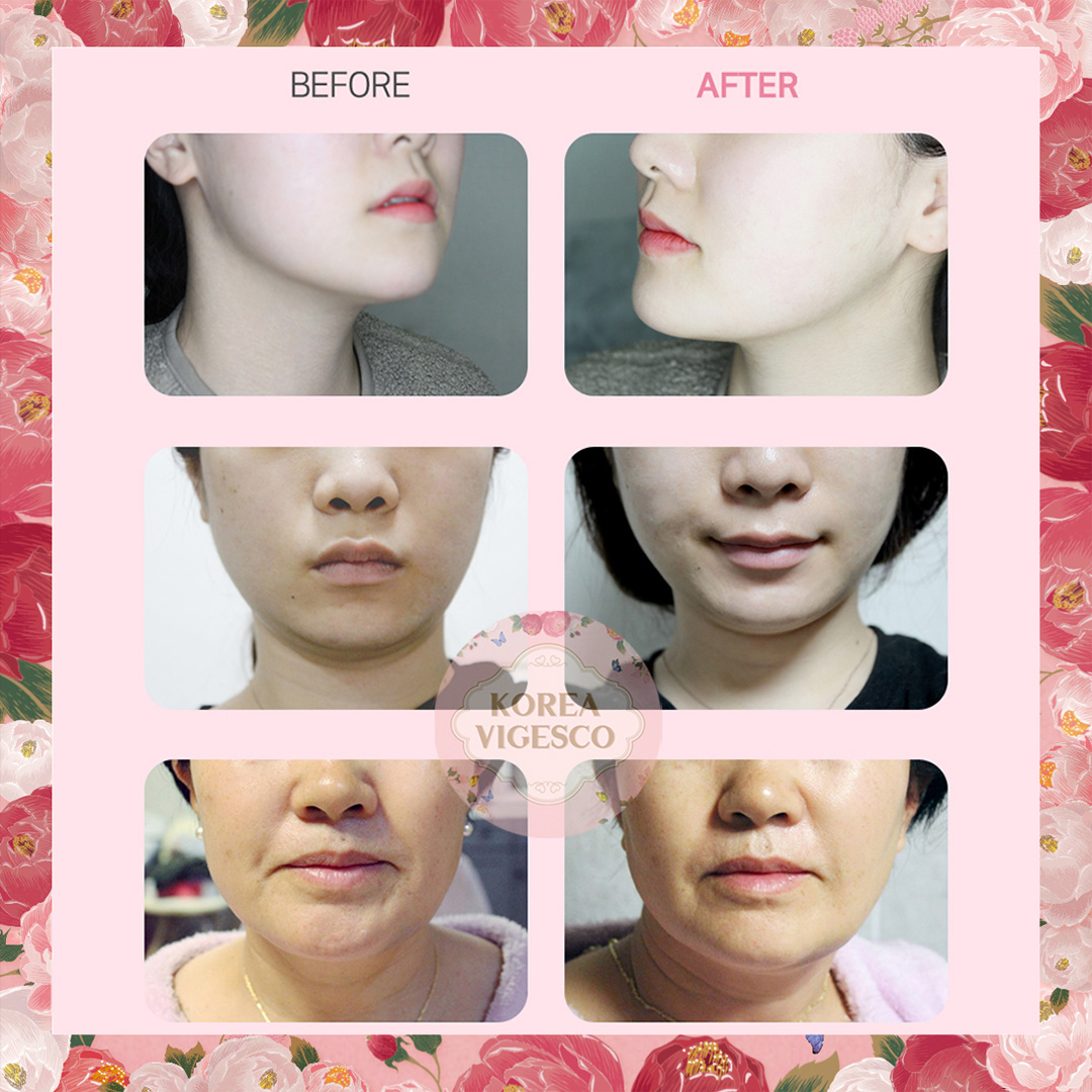 LOLOSKINNY V-LINE Sexy Face Chin Lifting Pack Double Chin Reducer ...