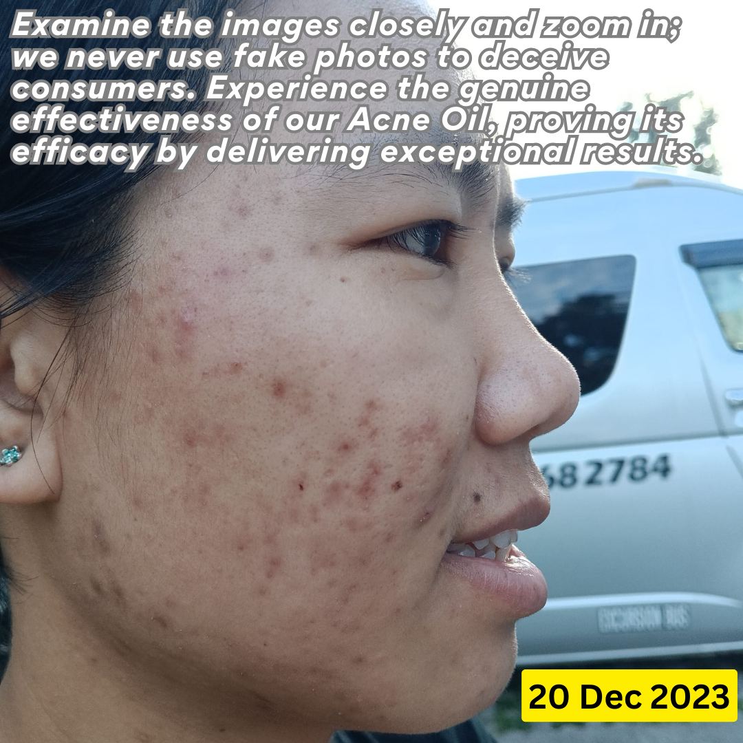 Acne (Cystic Acne Genuine Healer, 1000% work, no fake photos) | Shopee ...