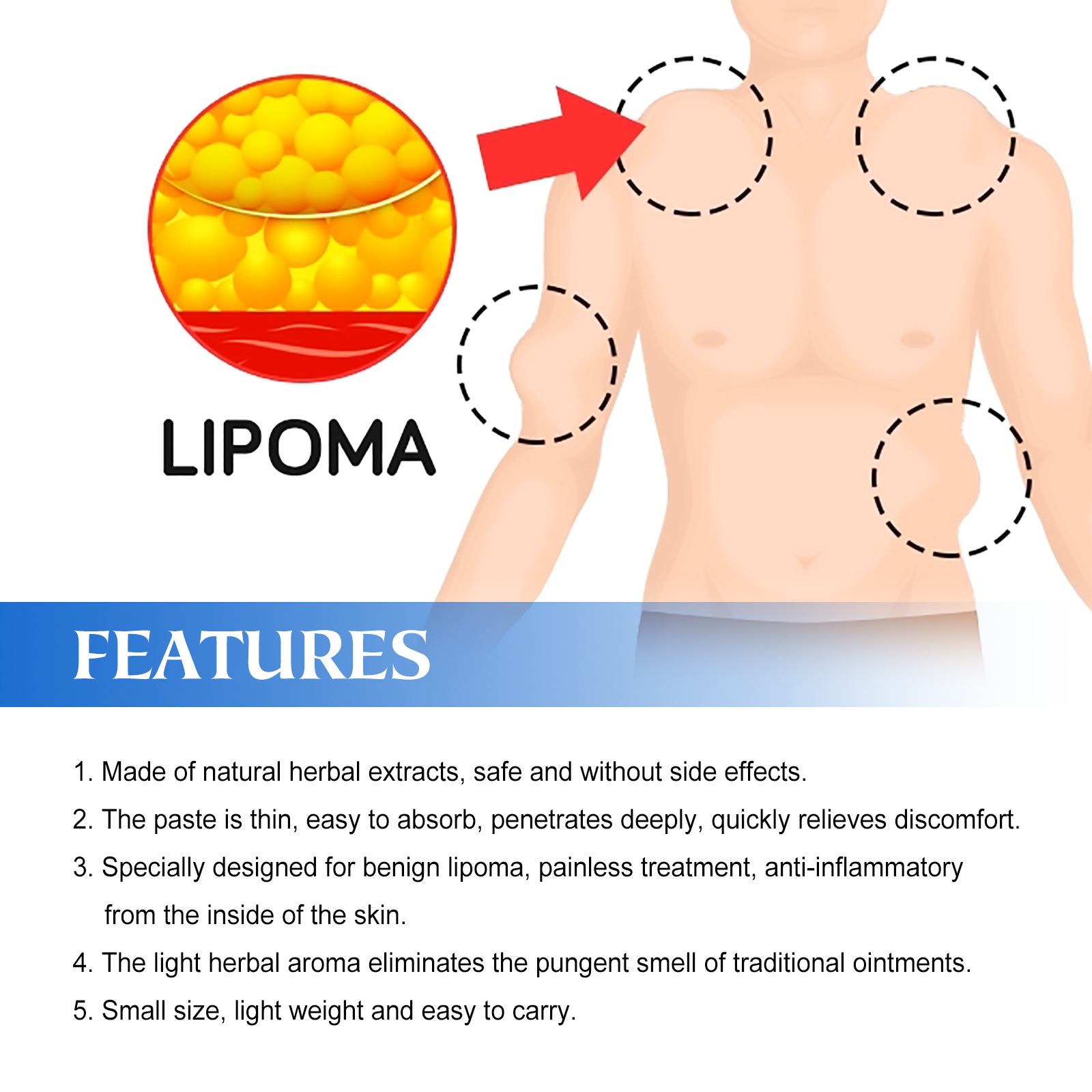 Lipoma Removal Cream Lipoma Cream Removing Lumps in the Body Treat ...