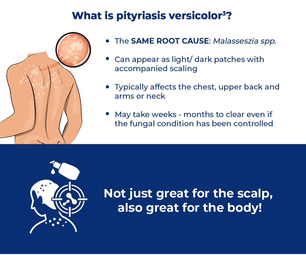 [NIZORAL OFFICIAL STORE]Nizoral® 2% Ketoconazole Anti-dandruff Shampoo ...