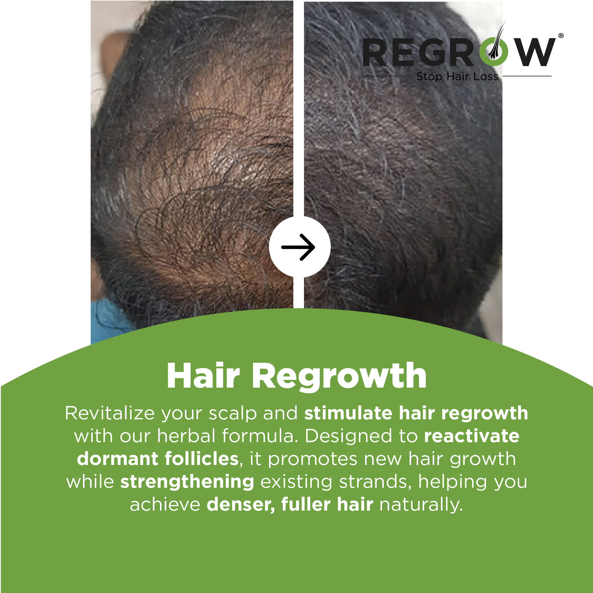 Regrow Hair Growth Tonic | Hair Loss Treatment Spray (120ml) | Shopee ...