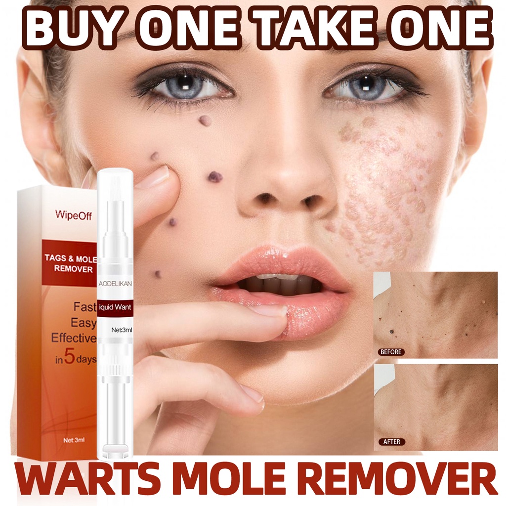 Mole Removal liquid Pen Warts Corn Skin Tag Remover Painless Removal ...