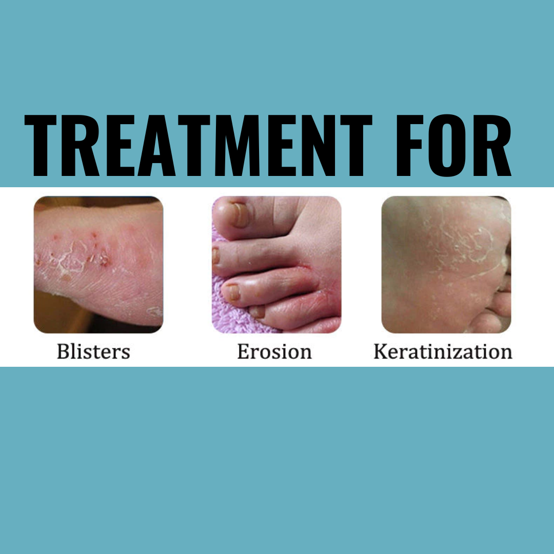 Tinea Kare 10g Antifungal Cream against Ringworm White Spot and ...