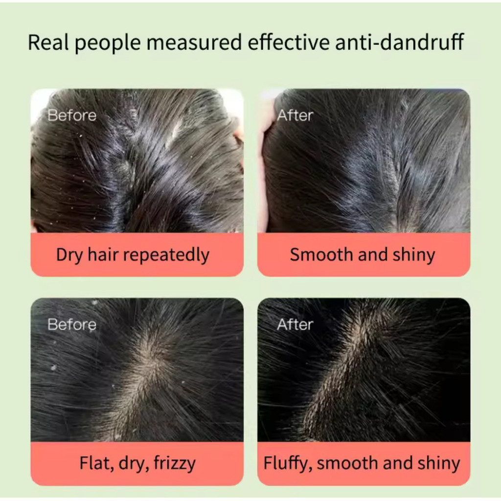 (FOREVER PREMIUM) Anti Dandruff Hair Shampoo Amino Acid Sea Salt Deep Cleansing Scalp Oil ...