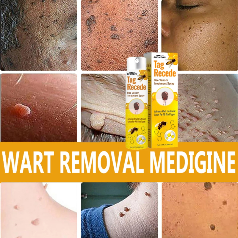 SG stock Bee venom wart remover cream / Safe painless Bee venom spray ...
