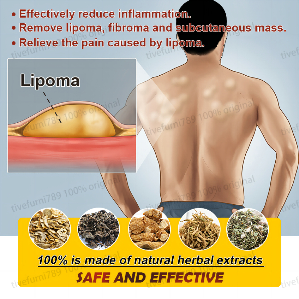 🌻SG stock🌻 𝑶𝒓𝒊𝒈𝒊𝒏𝒂𝒍 Lipoma removal cream/ Lipoma cream / Lipolysis fat ...
