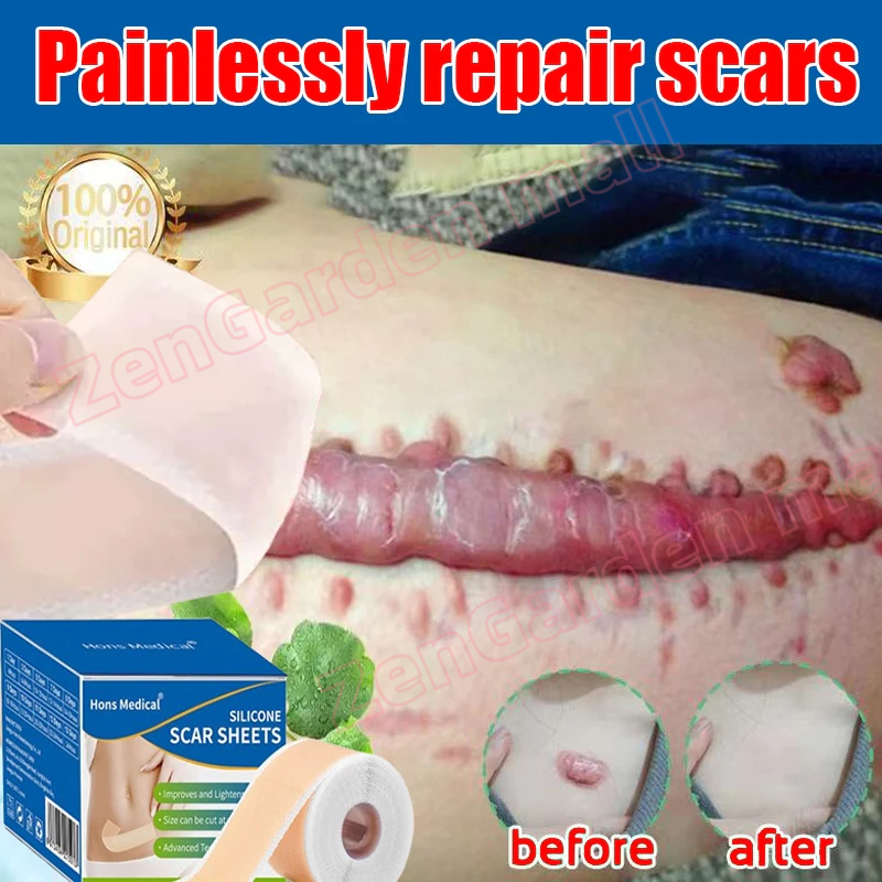 Scar Tape Medical Silicone Scar Sheet Scar Removal Scar Patch Keloid ...