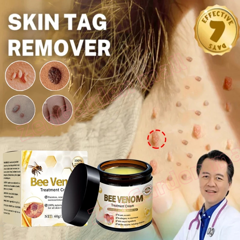 Warts Removal Cream Bee Venom Cream 60g Skin Tag Remover Wart Remover ...