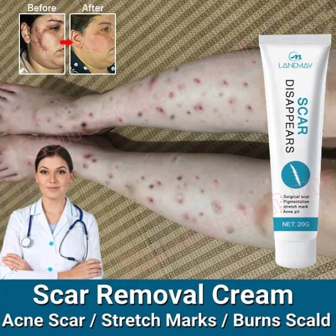 Mosquito Bite Scar Removal Cream Keloid Scar Removal Stretch Mark ...