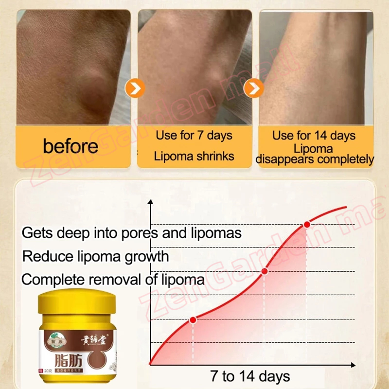 Lipoma Cream Lipoma removal cream Removing Lumps in the Body Removing Multiple Single Lipoma ...