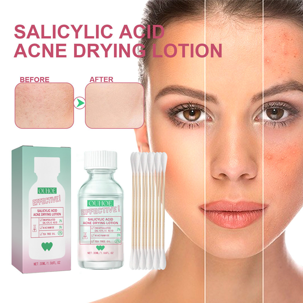 Ouhoe Salicylic Acid Acne Drying Lotion Gently Repair Acne-Prone ...