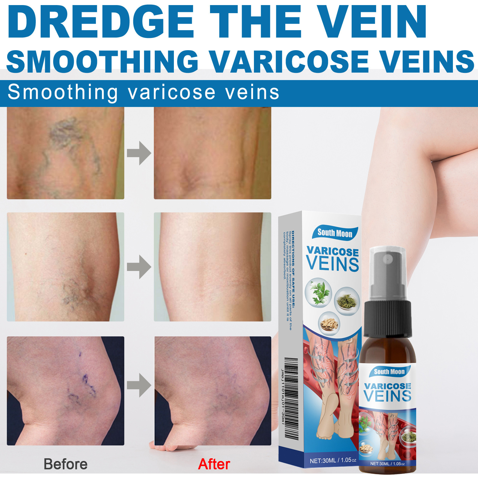 30ml Varicose Vein Spray assists in enhancing blood circulation and ...