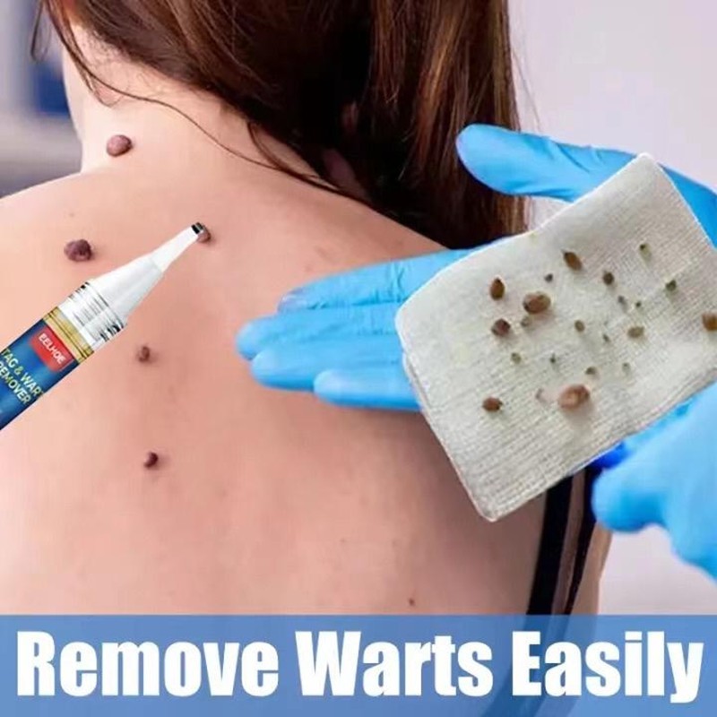 Mole removal removes moles on the face, freckles, warts, skin tags ...