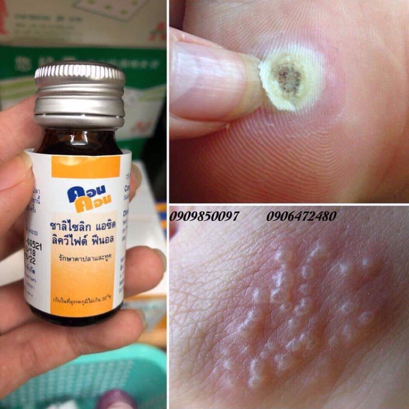 Concon Serum Breaks and Removes Warts, Back Skin, Chest Skin, Private ...