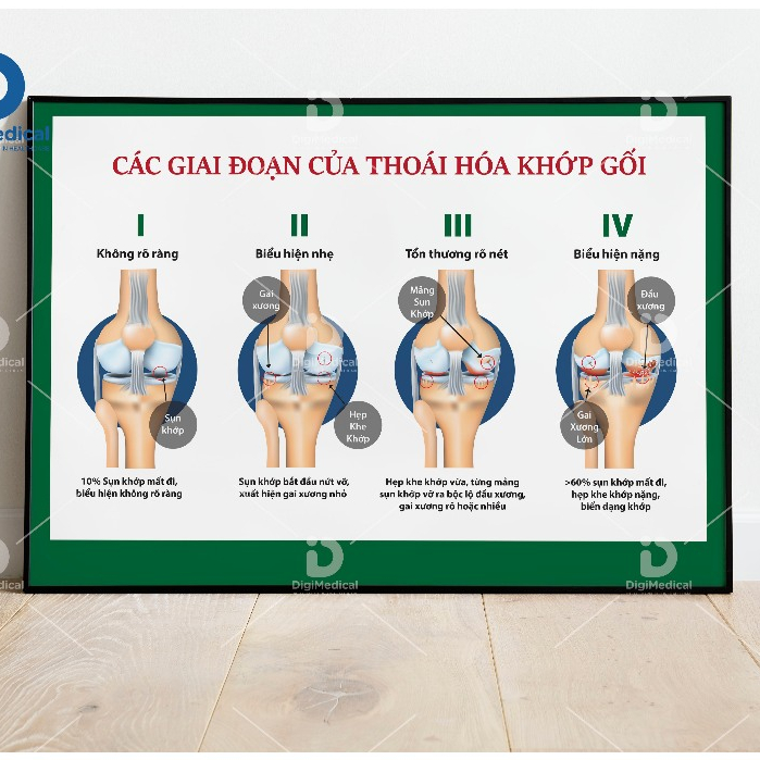 (Decal Sticker) Bone and Joint Painting: Stages of Knee Osteoarthritis ...
