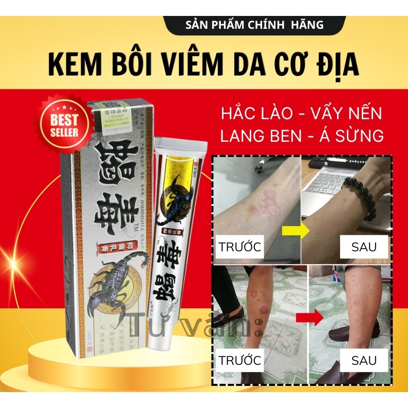 Effective Cream for Atopic Dermatitis, Fungus, Itching, Scorpion ...