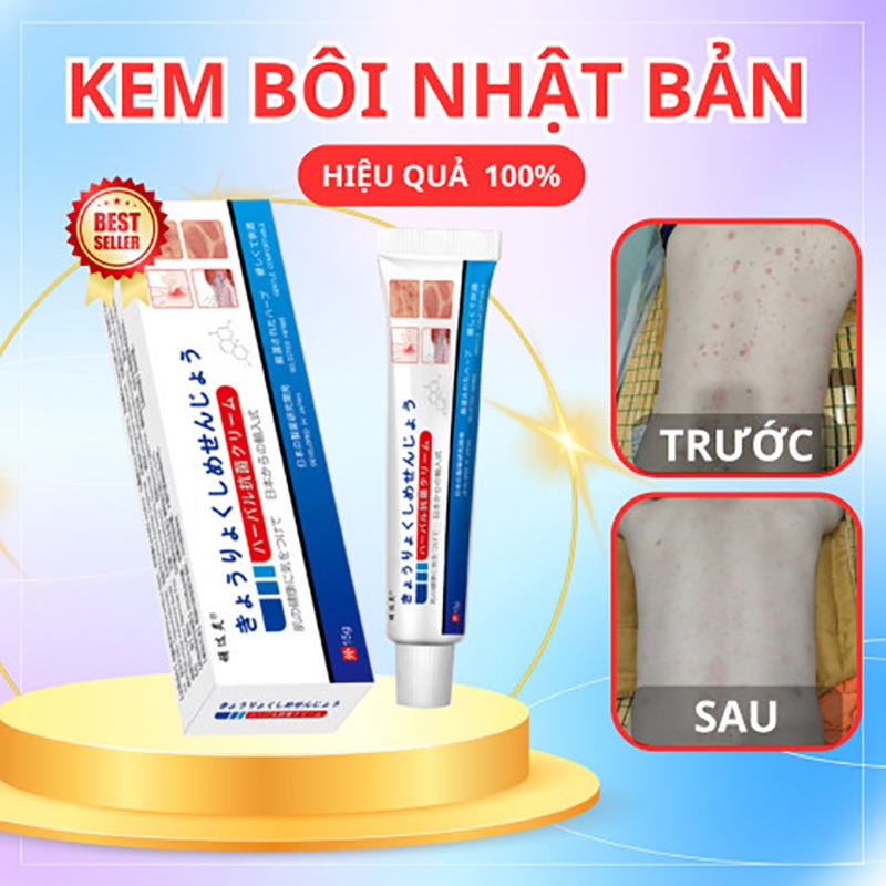 Effective Cream for Itchy Fungus, Atopic Dermatitis, Ringworm ...