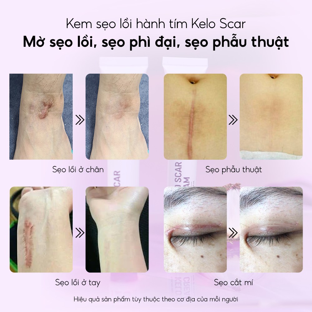 Kelo Scar Abera Keloid Scar Fading Cream - Supports the Fade of Keloid ...
